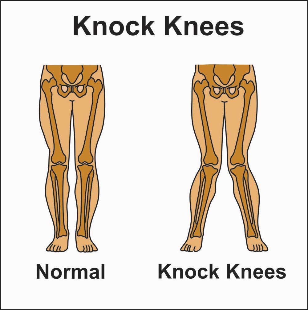 Postural Deformities Corrective